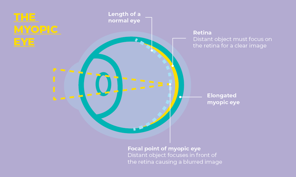 Myopia Symptoms In Children Post-Pandemic | Optical In Sight